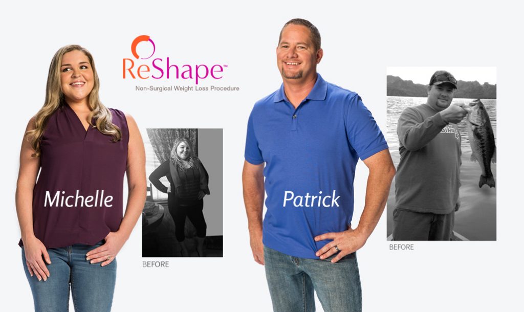 Reshape – Gastric Balloon – Ballem surgical